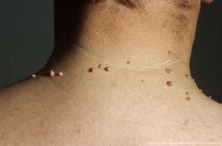 Acrocordons - Silvia Santilli Dermatologia